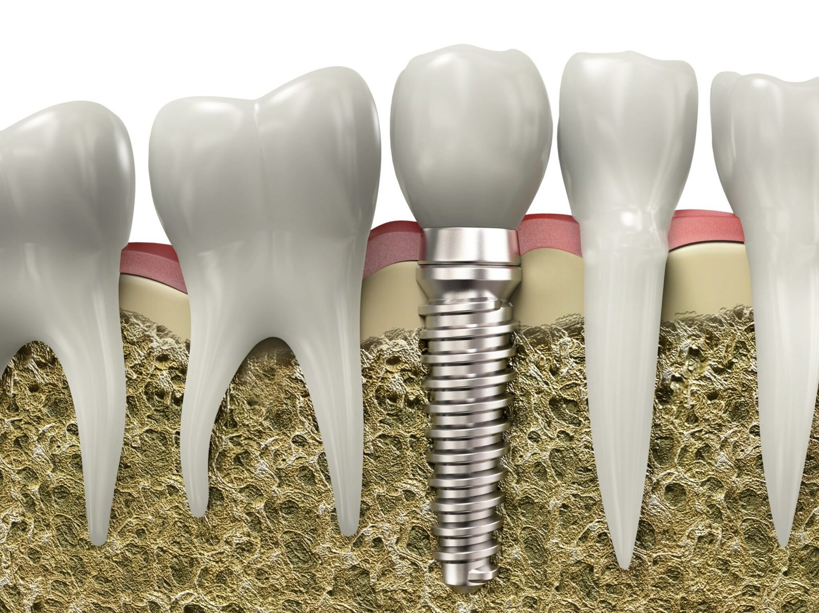 Types of Dental Implants: Which One Is Right for You? - Koreabeauty Guide