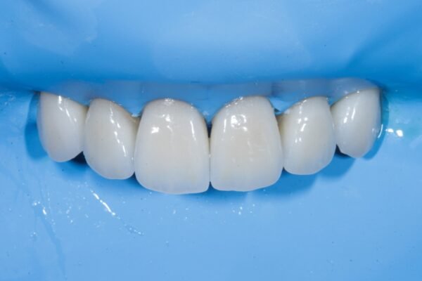 Full Porcelain Dental Bridge in Korea| Cost, Types, Doctors & Best ...