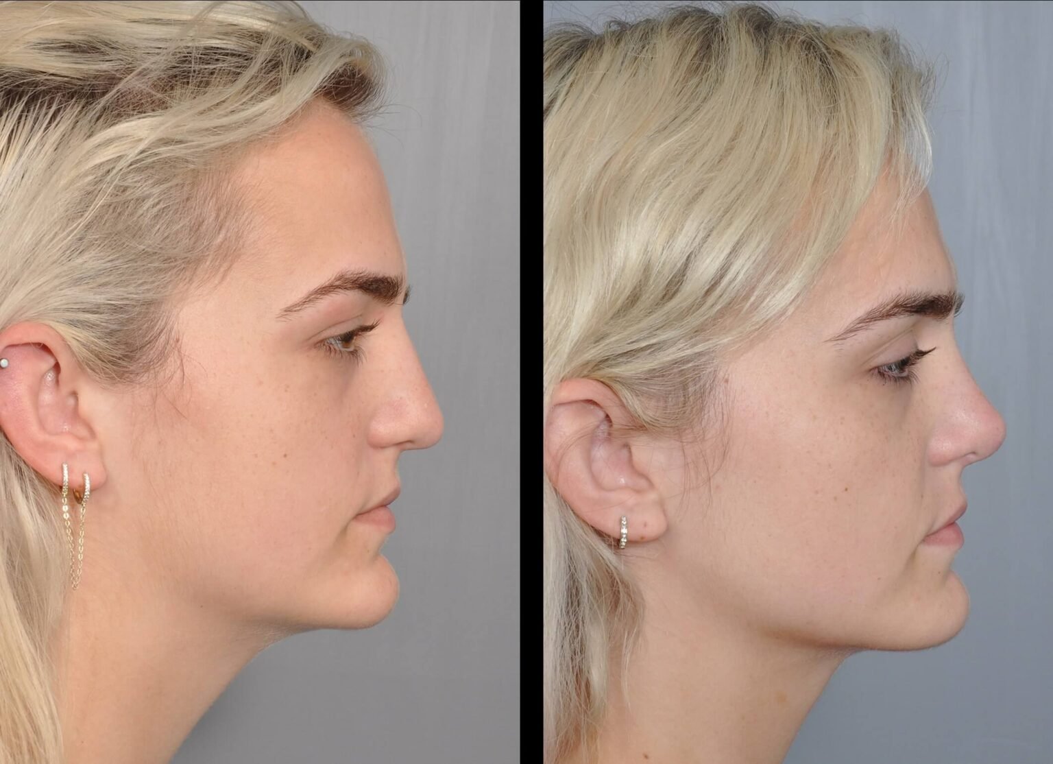 How Chin Implants Improve Facial Harmony and Profile - Koreabeauty Guide