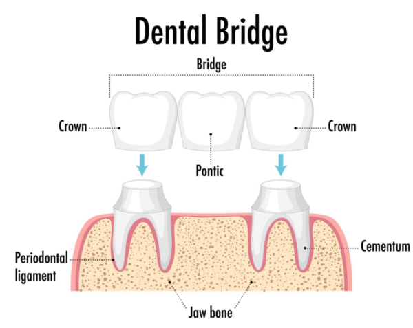All-Ceramic Dental Bridge in Korea| Cost, Types, Doctors & Best Seoul ...