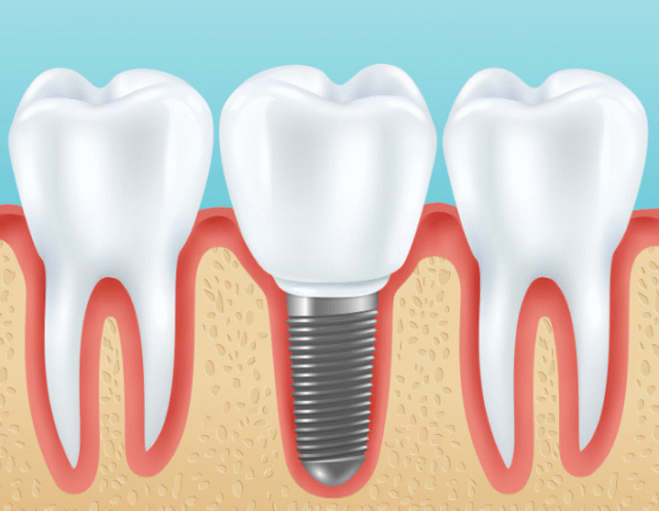 Implant-Supported Jaw Reconstruction in Korea| Cost, Types, Doctors ...